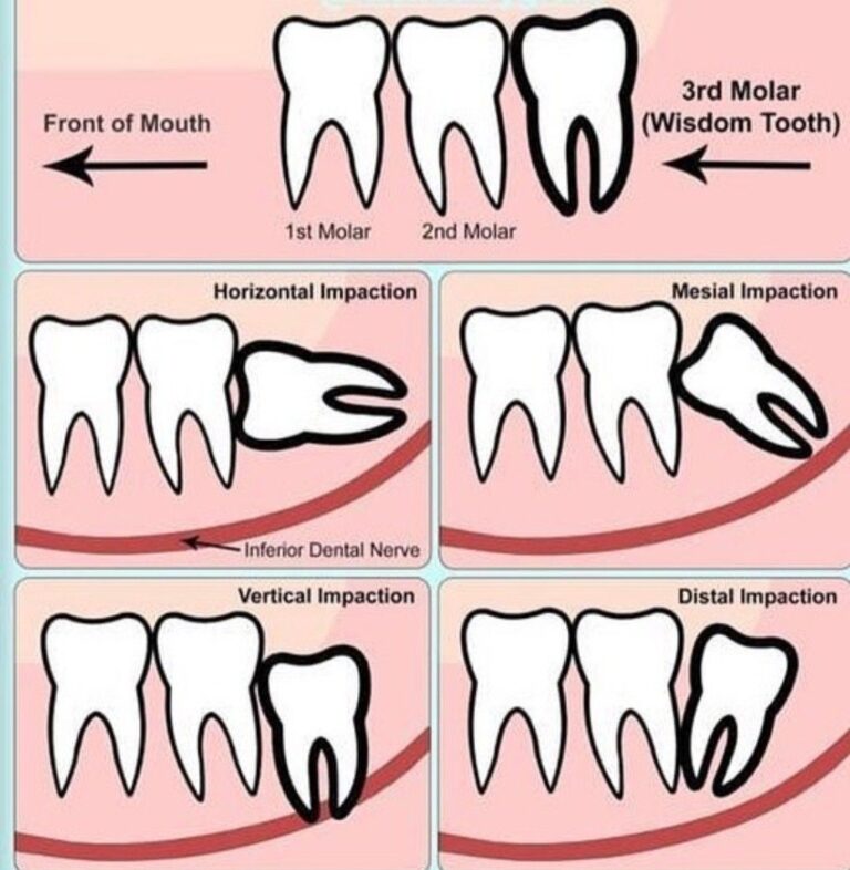 Root Canal on Wisdom Tooth. Is It OK to Do It? - Teethandtooth