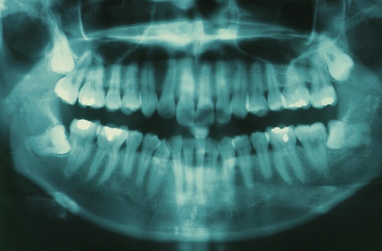 Removing Your Wisdom Teeth After 30? Here’s What You Need to Know ...
