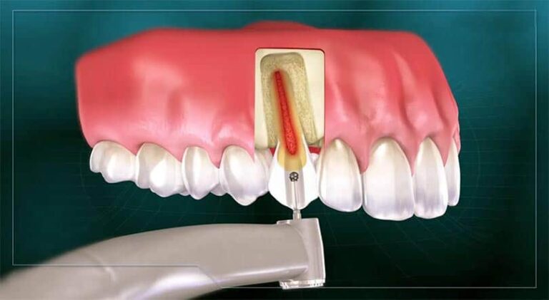 Root Canal on Front Tooth: What You Need to Know - Teethandtooth