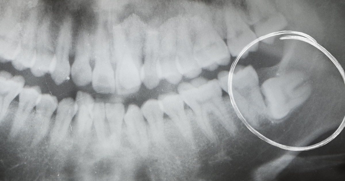 Horizontal Impacted Wisdom Tooth: Why It Happens and Should I Remove It ...