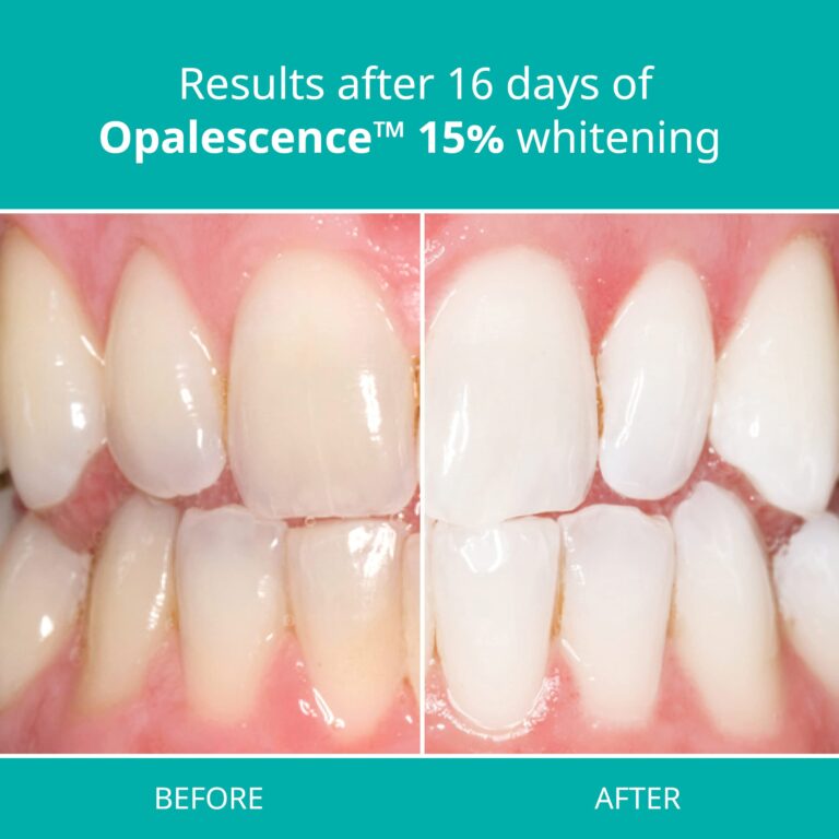 Opalescence 15% Instructions: How to Apply the Gel and Commonly Asked ...