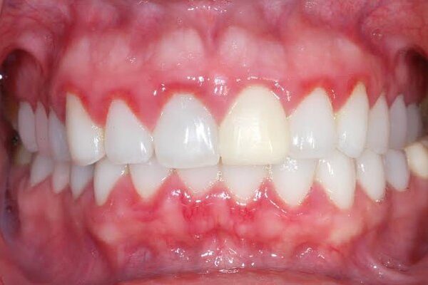 Should I Brush My Teeth Before Going to the Dentist? - Teethandtooth