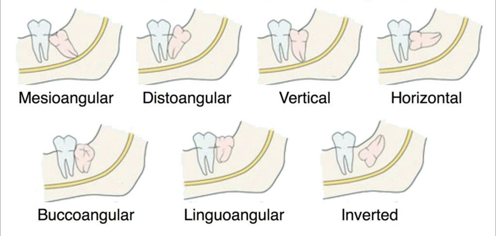 Can a Wisdom Teeth Fall Out Naturally On Its Own? - Teethandtooth
