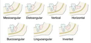 Is It Possible to Have 8 Wisdom Teeth and Why? - Teethandtooth