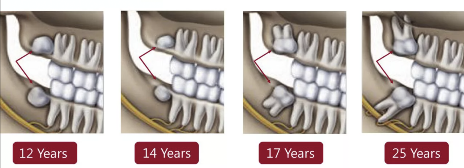 When Do Wisdom Teeth Exactly Come in? - Teethandtooth