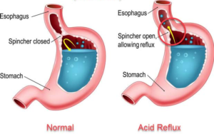 How Acid Reflux Erodes the Teeth and 10 Ways to Protect It - Teethandtooth