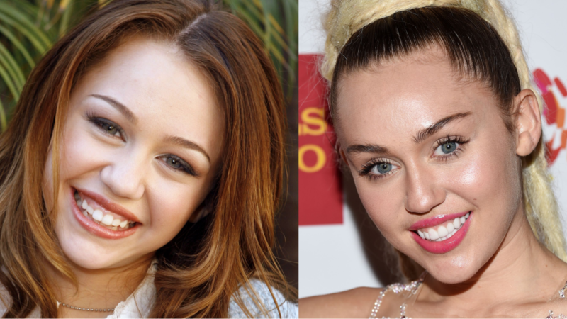All About Gummy Smile: What Is It and How to Fix It? - Teethandtooth