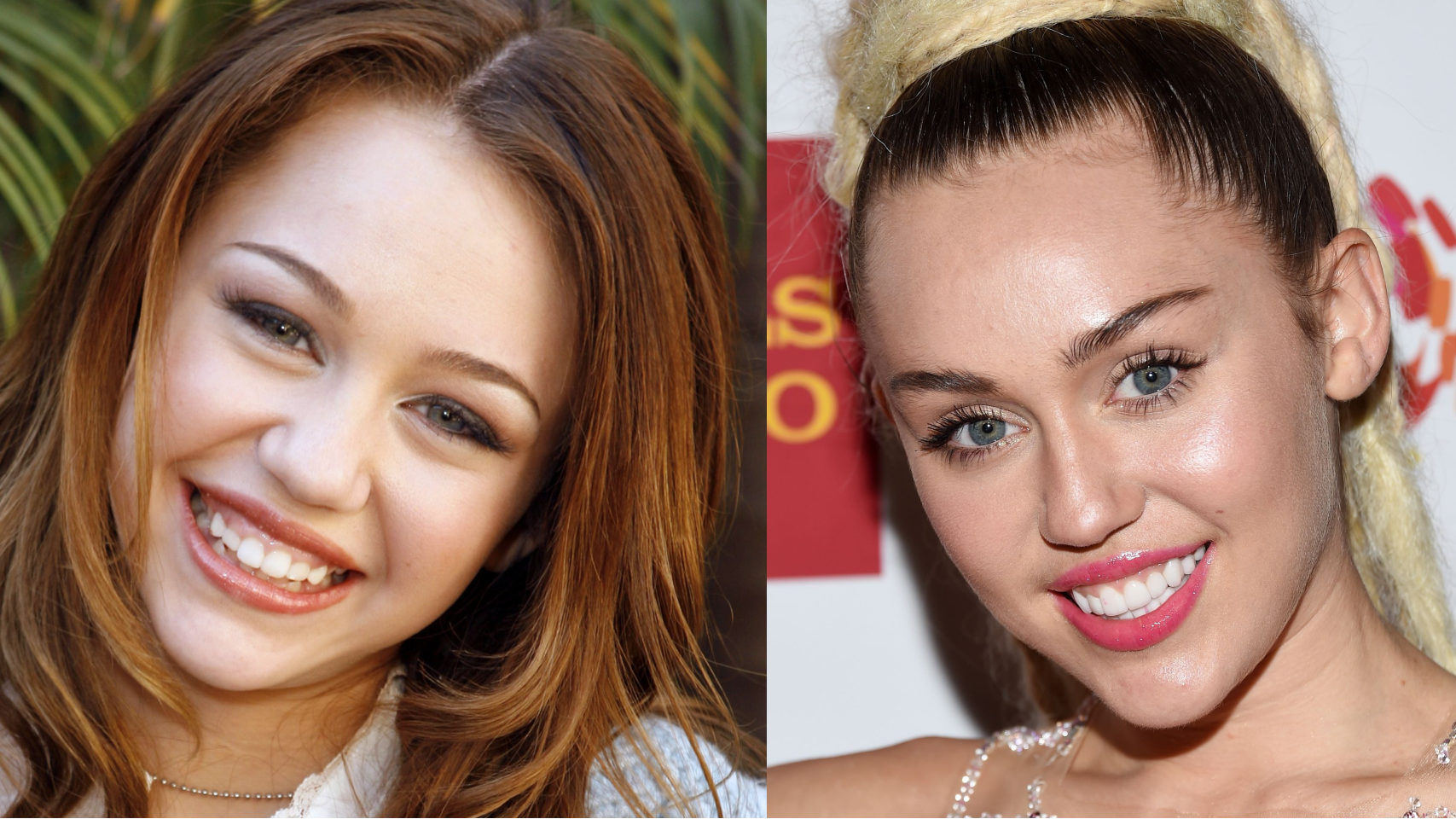 All About Gummy Smile: What Is It and How to Fix It? - Teethandtooth