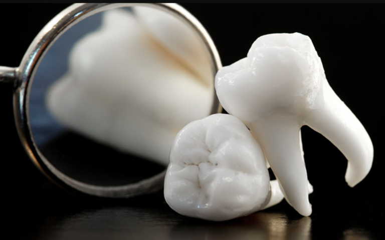How Many Roots Do Wisdom Teeth Have and Why It Matters - Teethandtooth